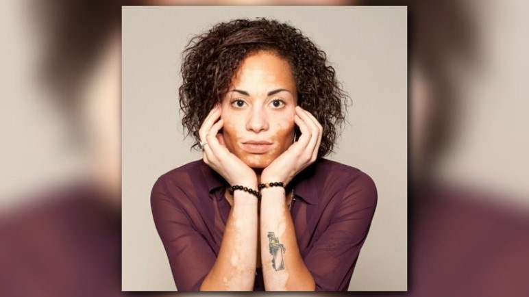 'Tough Skin' project sharing life with vitiligo through photos | 9news.com